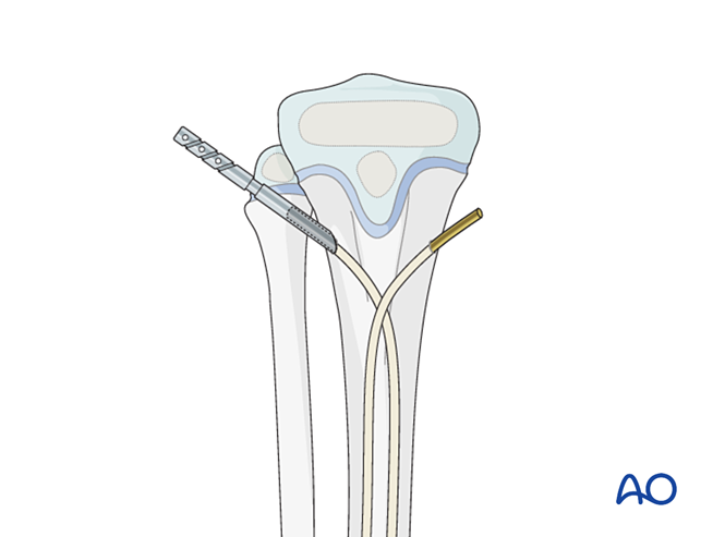 Elastic nailing for Simple complete fracture of the distal tibial ...