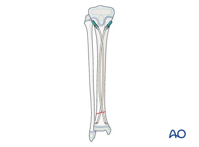 Elastic nailing for Simple complete fracture of the distal tibial ...