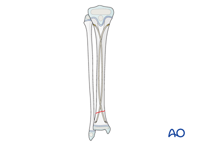 Elastic nailing for Simple complete fracture of the distal tibial ...