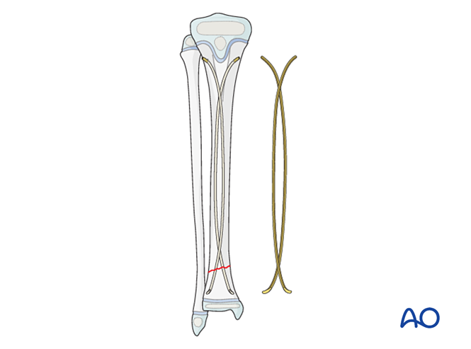 Elastic nailing for Simple complete fracture of the distal tibial ...