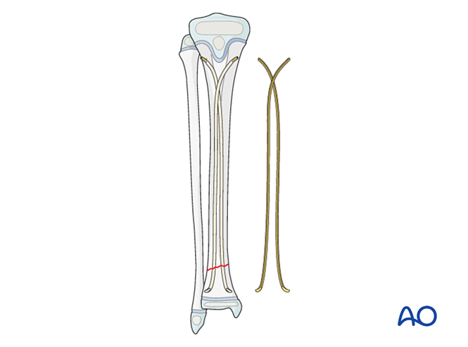 Elastic nailing for Simple complete fracture of the distal tibial ...