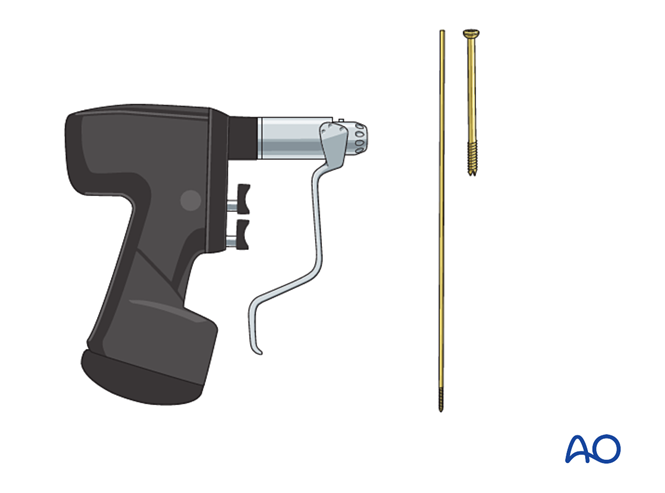 Closed reduction; screw fixation for Epiphysiolysis (Salter-Harris I ...