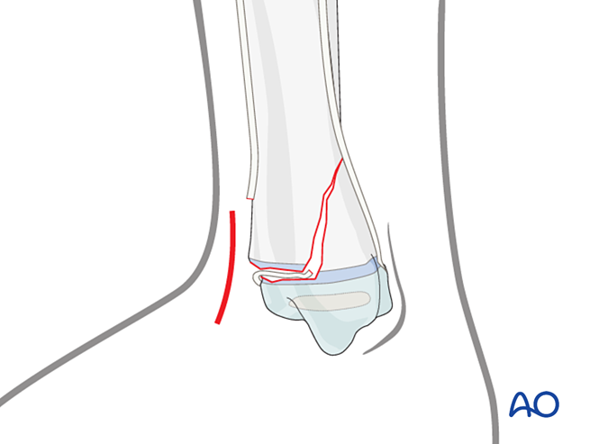 Open reduction; K-wire fixation for Epiphysiolysis with metaphyseal ...