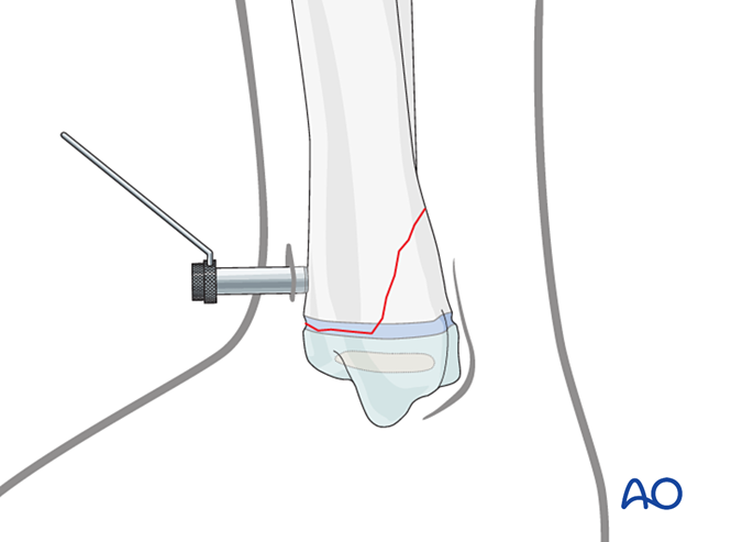 Closed reduction; screw fixation for Epiphysiolysis with metaphyseal ...