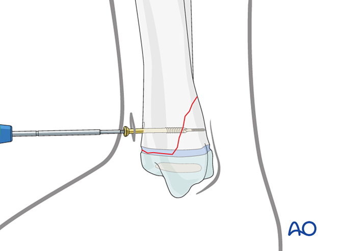 Closed reduction; screw fixation for Epiphysiolysis with metaphyseal ...