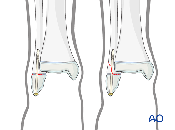 Closed reduction; screw fixation for Epiphysiolysis (Salter-Harris I ...