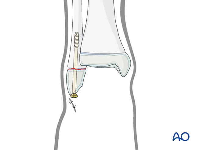 Closed reduction; screw fixation for Epiphysiolysis (Salter-Harris I ...