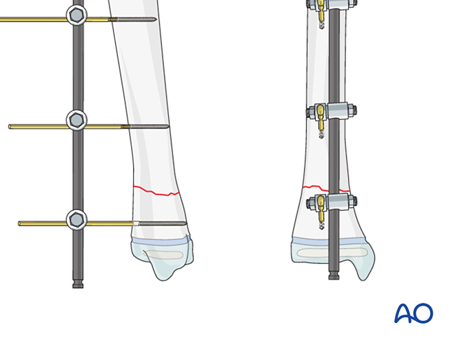 MIO bridge plating for Simple complete fracture of the distal tibial ...