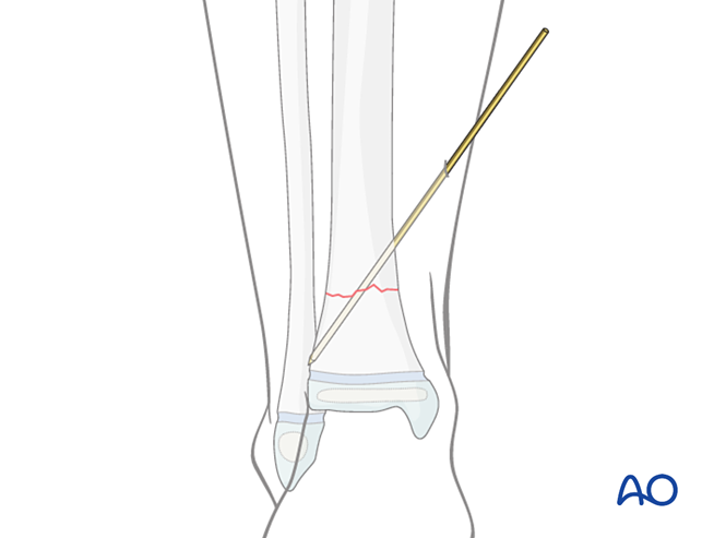 MIO bridge plating for Simple complete fracture of the distal tibial ...