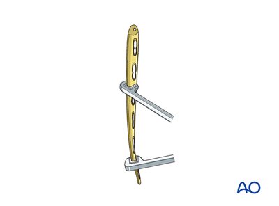 MIO bridge plating for Simple complete fracture of the distal tibial ...