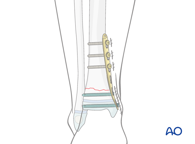 MIO bridge plating for Simple complete fracture of the distal tibial ...