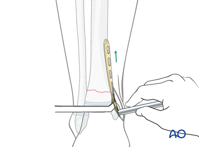 MIO bridge plating for Simple complete fracture of the distal tibial ...