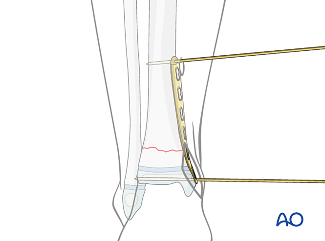 MIO bridge plating for Simple complete fracture of the distal tibial ...