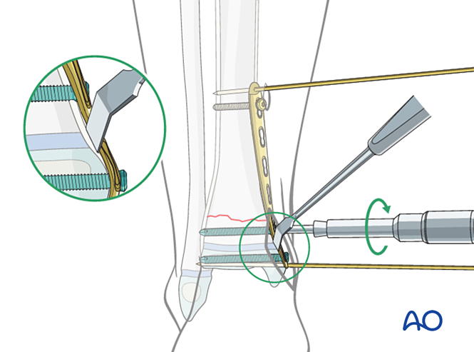 MIO bridge plating for Simple complete fracture of the distal tibial ...