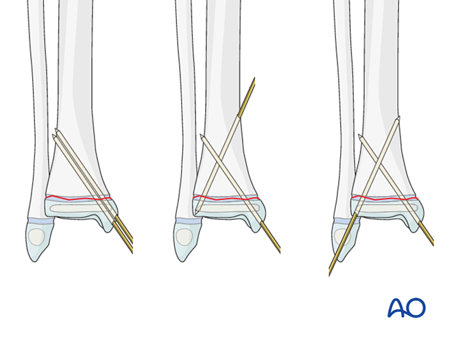 Open reduction; K-wire fixation for Epiphysiolysis (Salter-Harris I) of ...