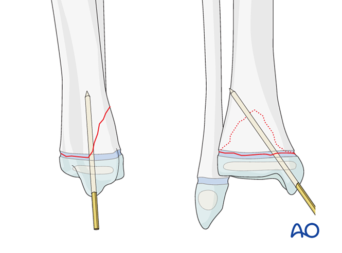Open reduction; K-wire fixation for Epiphysiolysis with metaphyseal ...