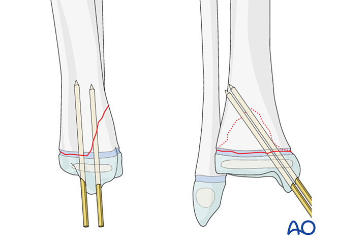 Open Reduction K Wire Fixation For Epiphysiolysis With Metaphyseal