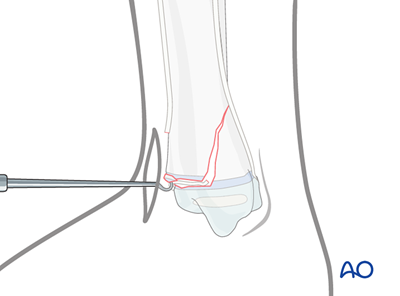 Open reduction; screw fixation for Epiphysiolysis with metaphyseal ...