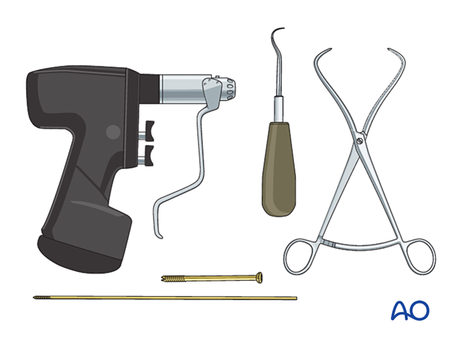 Open reduction; screw fixation for Anterolateral epiphyseal fractures ...