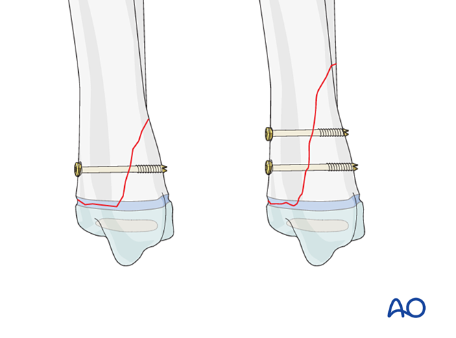Open reduction; screw fixation for Epiphysiolysis with metaphyseal ...