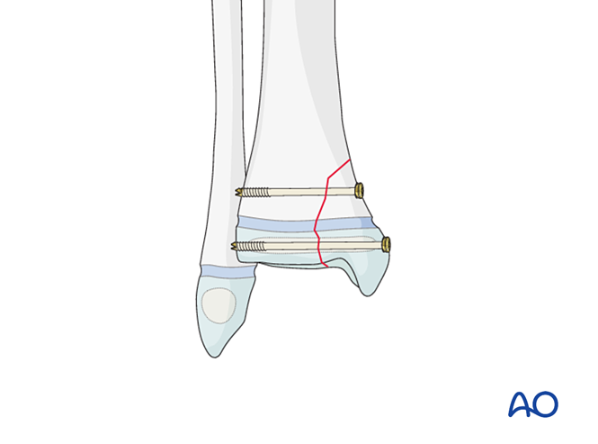 Open reduction; screw fixation for Epi-/metaphyseal fractures (Salter ...
