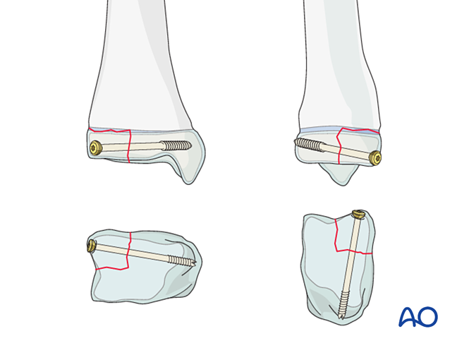 Open reduction; screw fixation for Anterolateral epiphyseal fractures ...