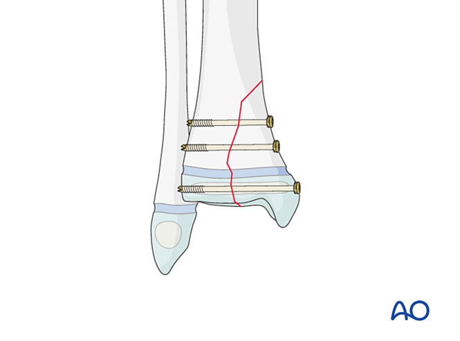 Open reduction; screw fixation for Epi-/metaphyseal fractures (Salter ...