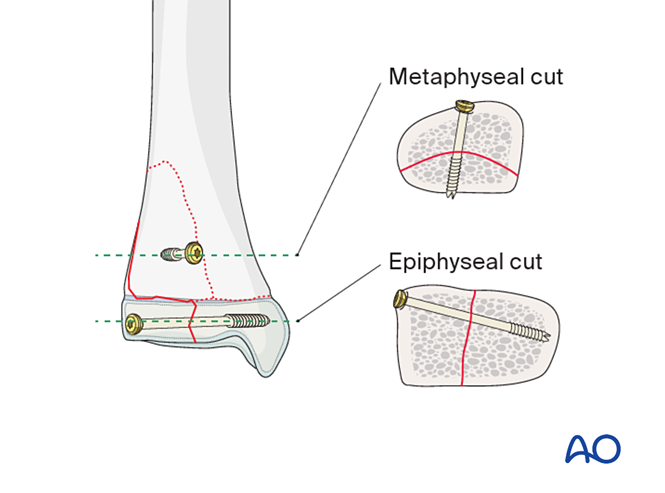 Open reduction; screw fixation for Complex epi-/metaphyseal fractures ...