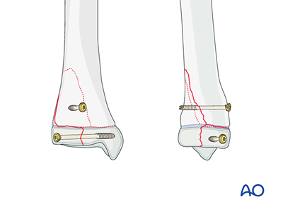 Open reduction; screw fixation for Complex epi-/metaphyseal fractures ...