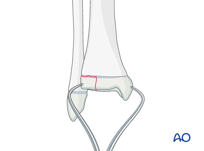 Open reduction; screw fixation for Anterolateral epiphyseal fractures ...