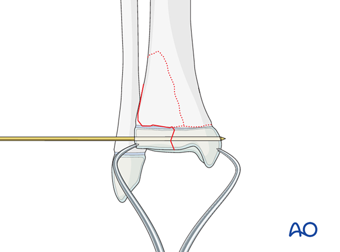 Open reduction; screw fixation for Complex epi-/metaphyseal fractures ...