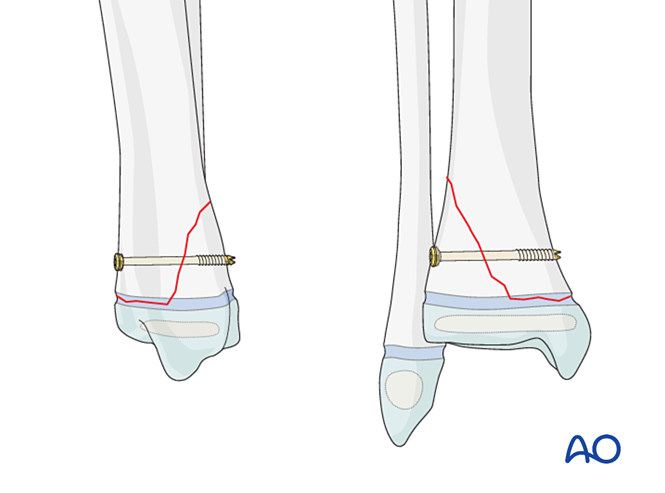 Open reduction; screw fixation for Epiphysiolysis with metaphyseal ...