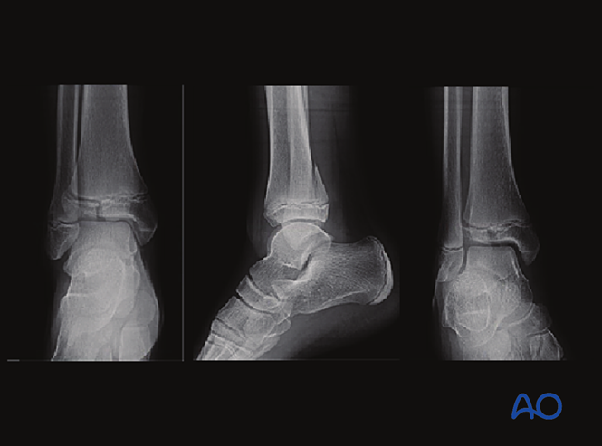 Open reduction; screw fixation for Complex epi-/metaphyseal fractures ...
