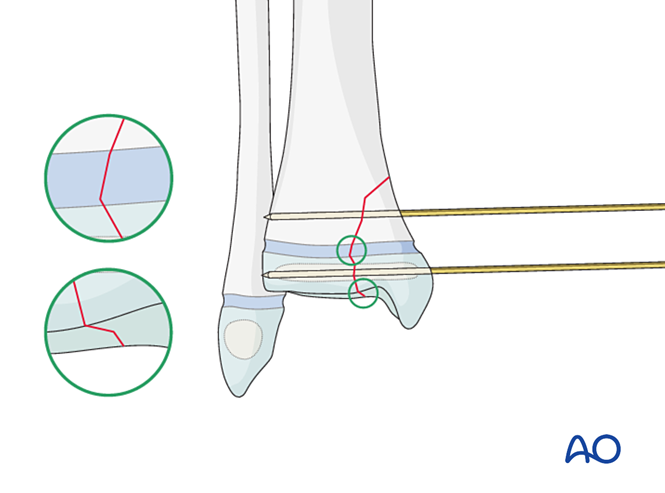 Open reduction; screw fixation for Epi-/metaphyseal fractures (Salter ...