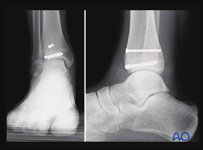 Open reduction; screw fixation for Complex epi-/metaphyseal fractures ...