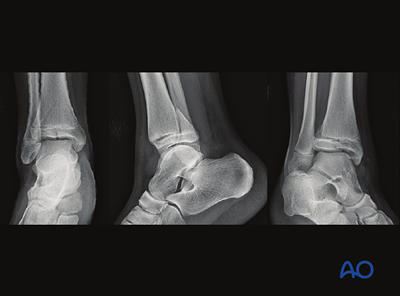 Open reduction; screw fixation for Complex epi-/metaphyseal fractures ...