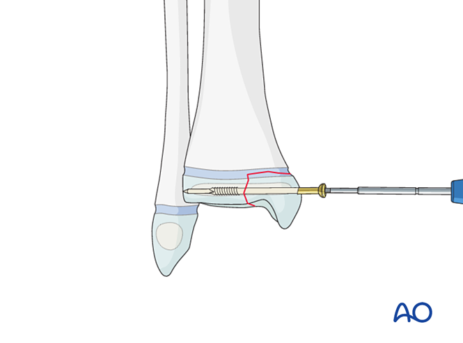 Open reduction; screw fixation for Epiphyseal fractures (Salter-Harris ...