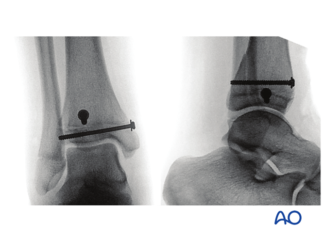 Open reduction; screw fixation for Complex epi-/metaphyseal fractures ...