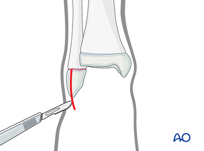 Open reduction; screw fixation for