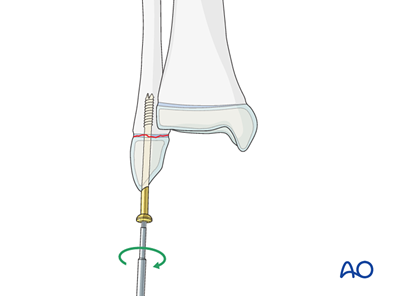 Open reduction; screw fixation for