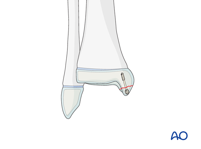 Open reduction; screw fixation for Avulsion fractures of the medial ...