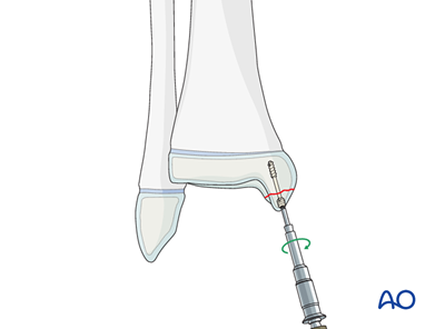 Open reduction; screw fixation for Avulsion fractures of the medial ...