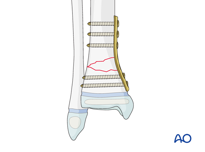 Open reduction; plate fixation for Multifragmentary complete fracture ...