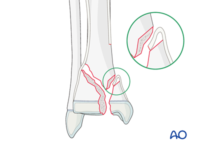 Open reduction; plate fixation for Epi-/metaphyseal fractures (Salter ...