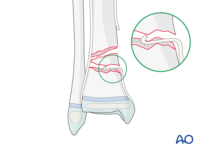 Open reduction; plate fixation for Multifragmentary complete fracture ...