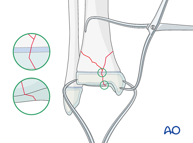 Open reduction; plate fixation for Epi-/metaphyseal fractures (Salter ...