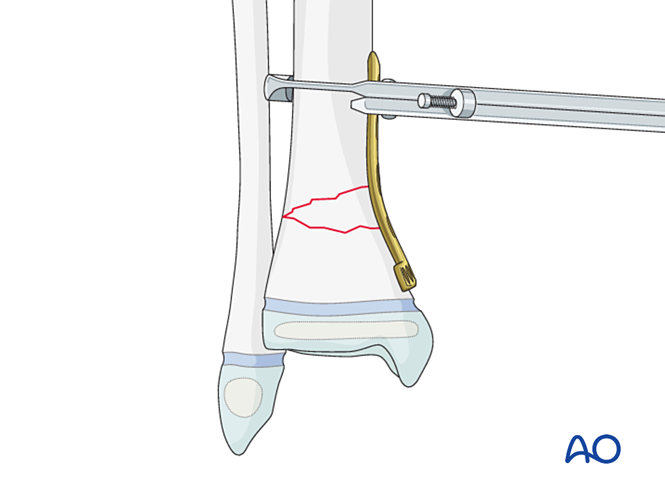 Open reduction; plate fixation for Multifragmentary complete fracture ...