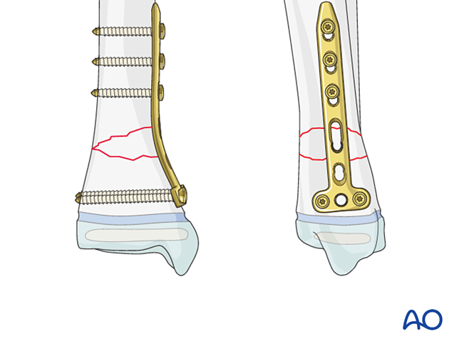 Open reduction; plate fixation for Multifragmentary complete fracture ...