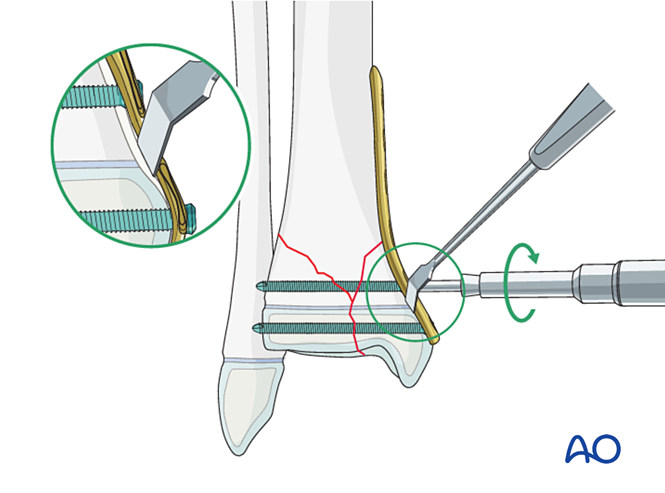 Open reduction; plate fixation for Epi-/metaphyseal fractures (Salter ...