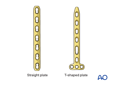 Open reduction; plate fixation for Epi-/metaphyseal fractures (Salter ...